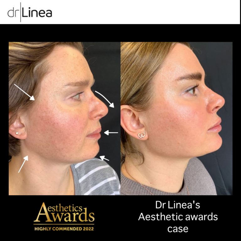 Dermal Fillers Norwich - Lips, Cheek, Face, Chin | Dr Linea