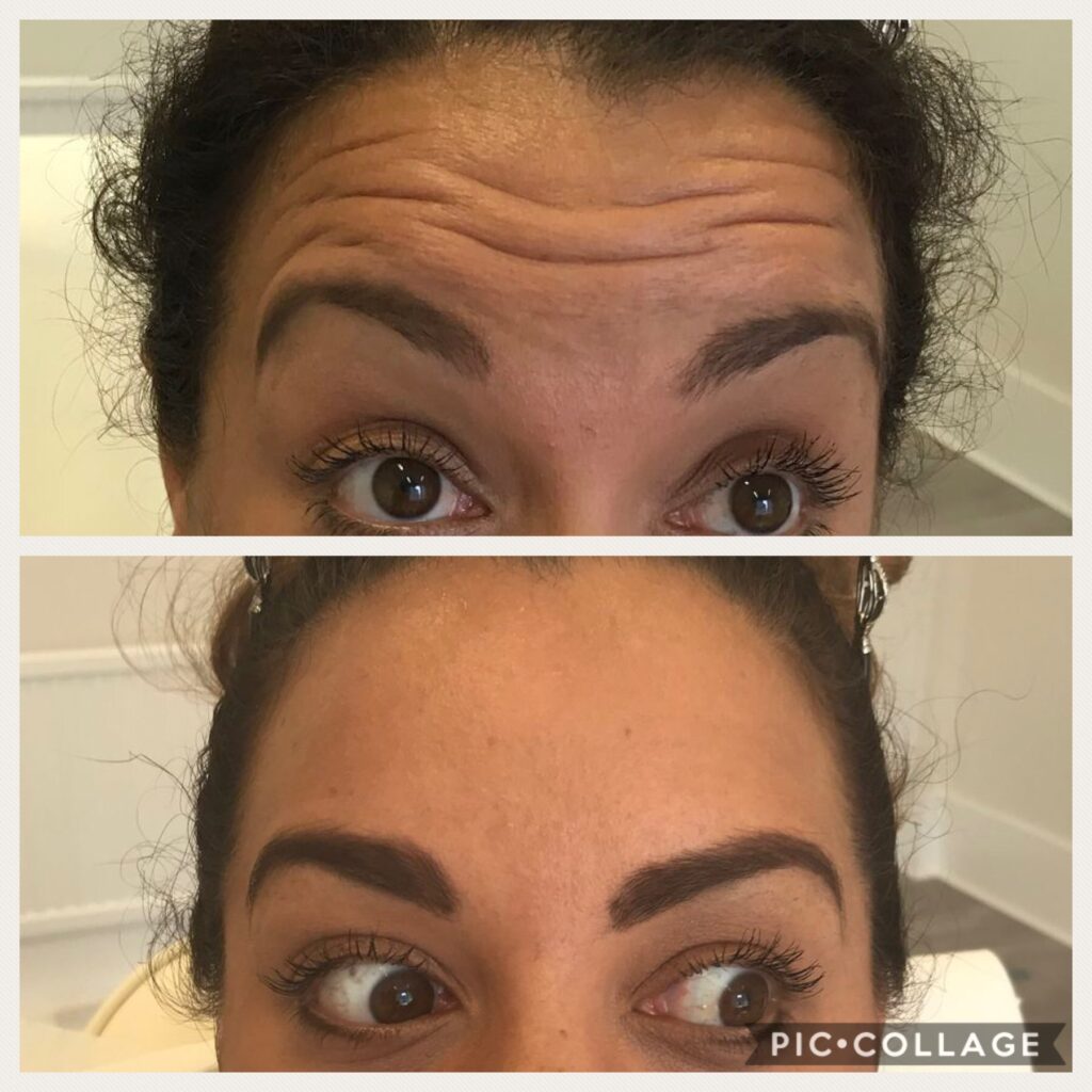 Anti-wrinkle Injections in Ipswich - Dr Linea