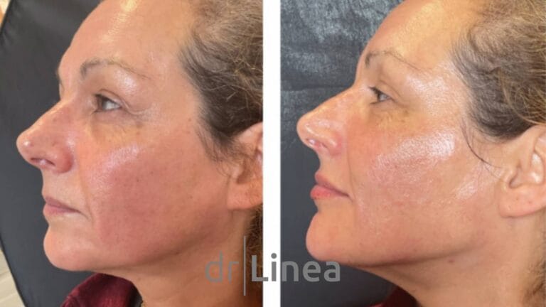 Natural looking dermal fillers for facial rejuvenation - Dr Linea